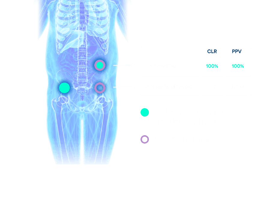 PYLARIFY® & Biochemically Recurrent PCa | Condor Trial
