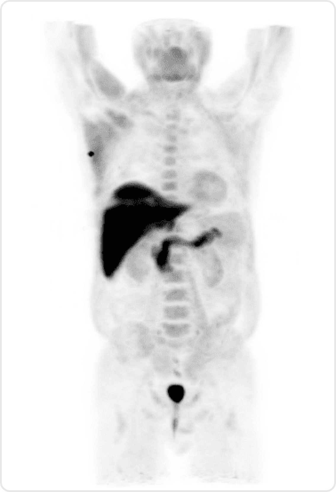 PYLARIFY® Case Studies | PYLARIFY®