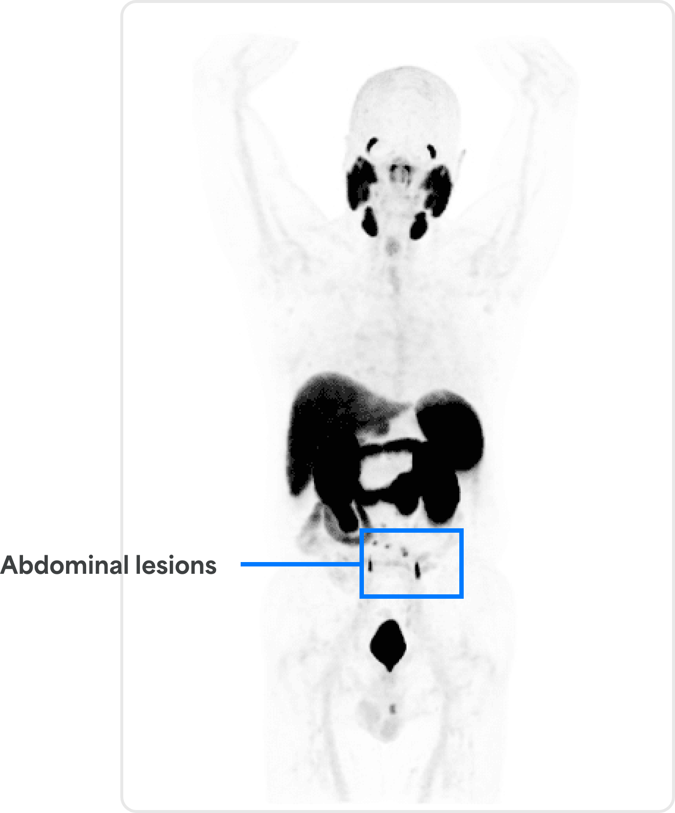PYLARIFY® Case Studies | PYLARIFY®