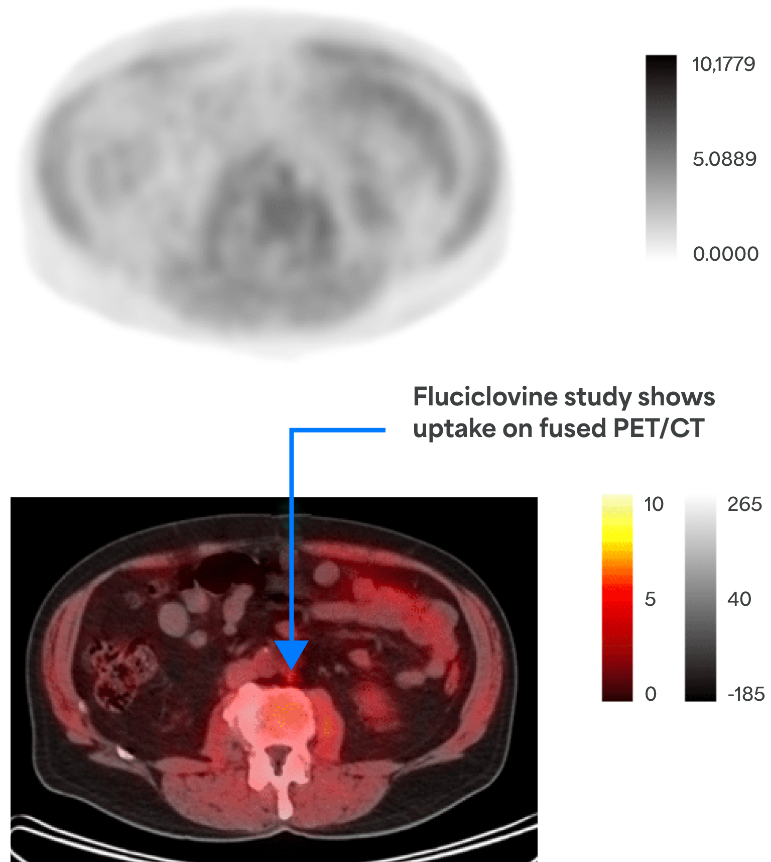 PYLARIFY® Case Studies | PYLARIFY®